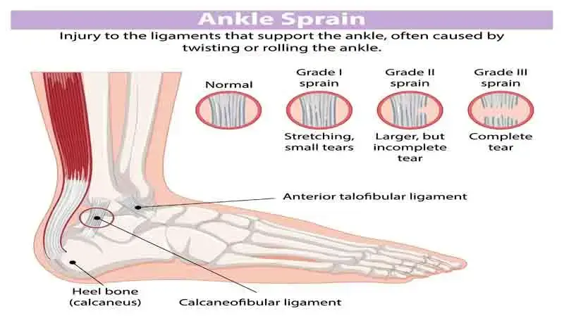 Ligament Sprain Treatment Guide For Torn Ankle Ligament