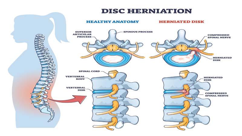 Understanding Slip Discs: What Causes It and How to Manage the Pain