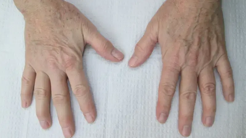 Heberden39s Nodes Causes Symptoms And Treatment Swollen Lymph Nodes: