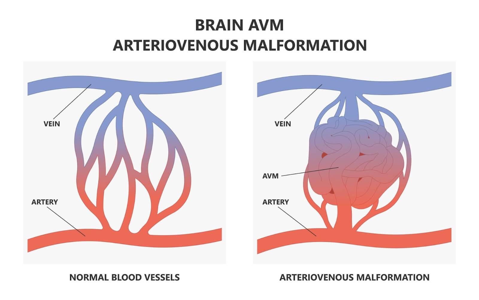 Brain Lesions : Causes, Symptoms, and Treatment