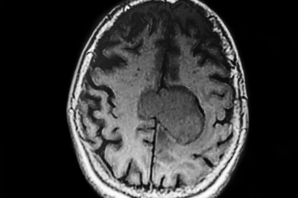 Brain Lesions : Causes, Symptoms, and Treatment