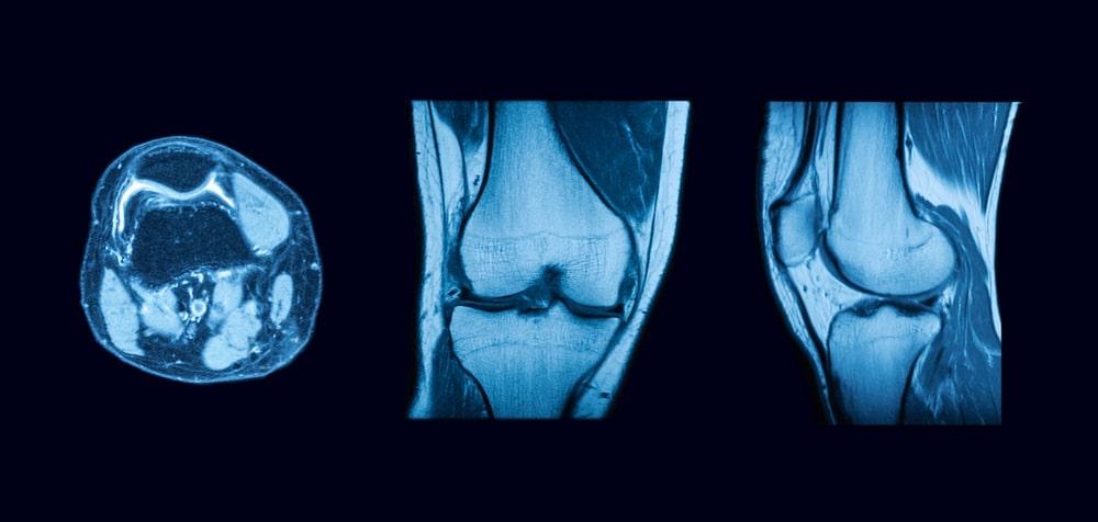 Magnetic resonance imaging (MRI) of right knee, Knee joint effusion and ...
