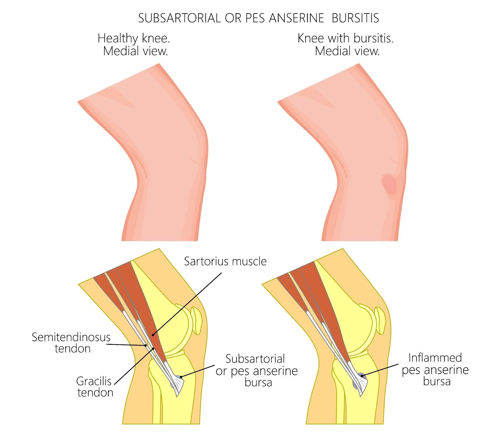 Pes Anserine Bursitis