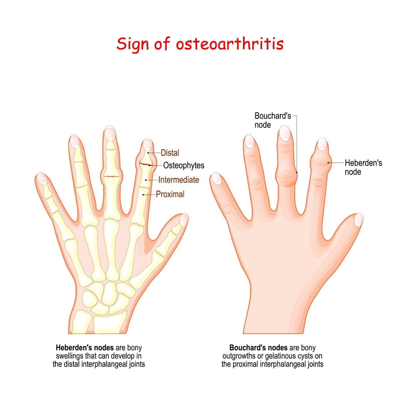 Heberden S Nodes Mucous Cyst — The Manchester Hand Clinic