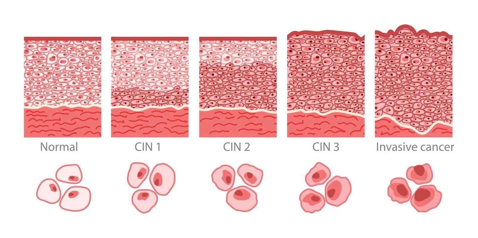 Stages of Cervical Cancer