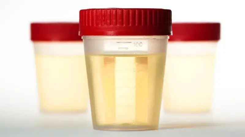 Nitrite Positive Urine