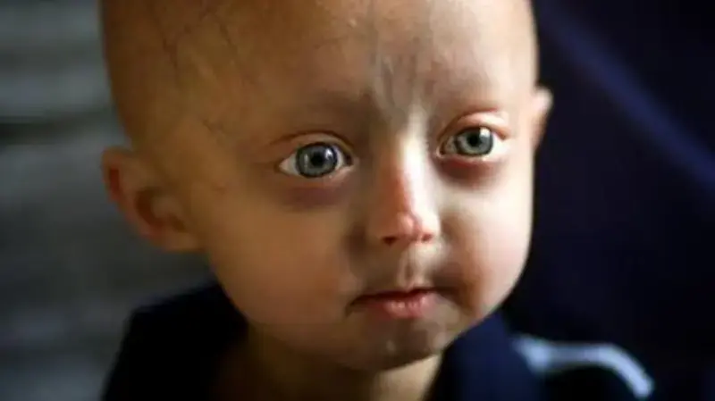 Agent Orange Effects