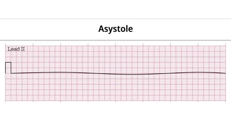 Asystole