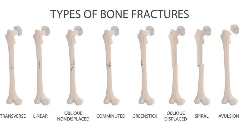 Type Of Bone Fractures