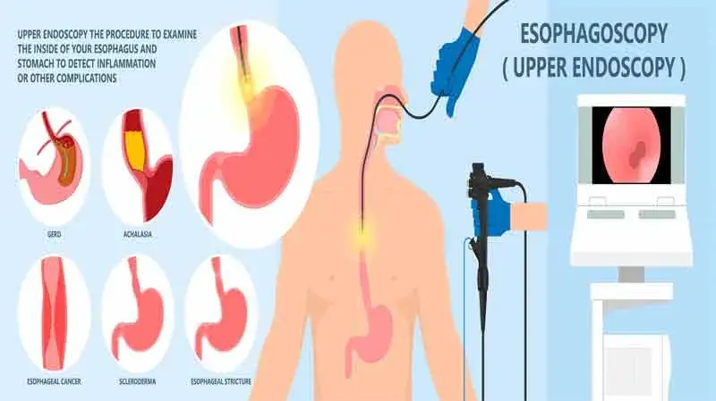Endoscopy Meaning Endoscopy An Overview Sciencedirect Topics 3622