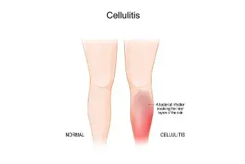 cellulitis-causes-symptoms-and-treatments-options_image