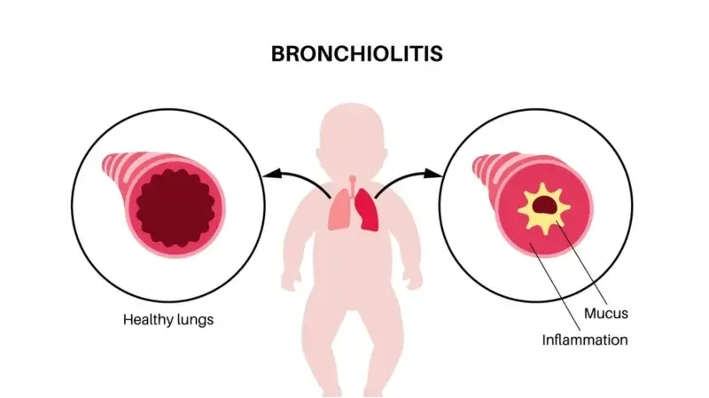 WHAT IS BRONCHIOLITIS: SYMPTOMS, CAUSES, DIAGNOSIS, AND MORE - Chiid Health