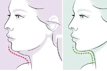 what-is-genioplasty-or-chin-job_image