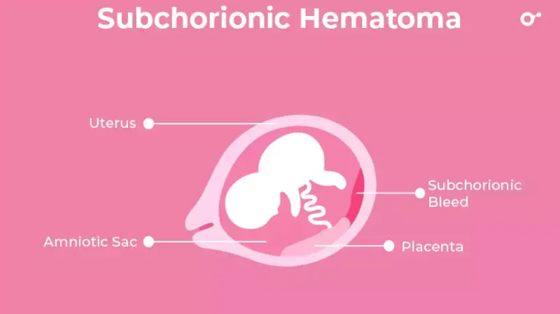 Subchorionic Hematoma