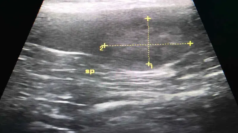 Hypoechoic Ultrasound