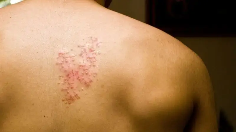 Shingles overview with causes, symptoms, diagnosis, and treatment explained