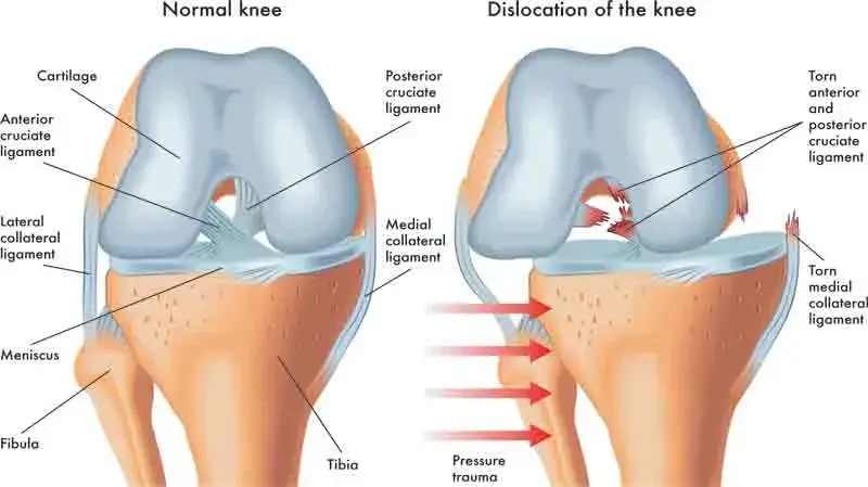 Congenital Knee Dislocation