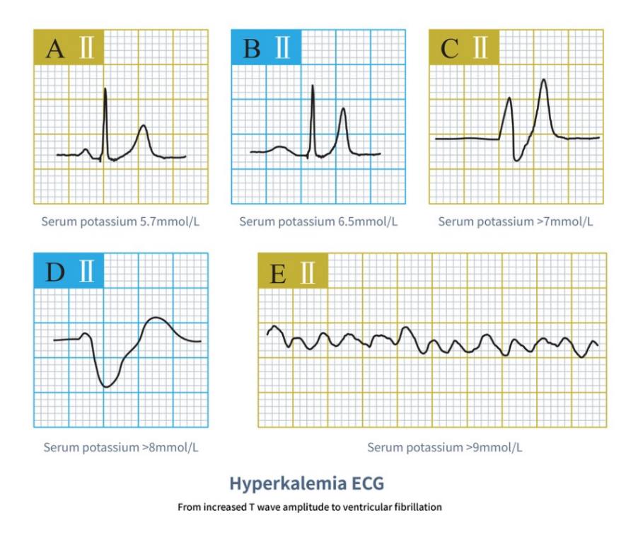 Hyperkalemia Causes Signs Symptoms Ecg Changes And Hyperkalemia ECG
