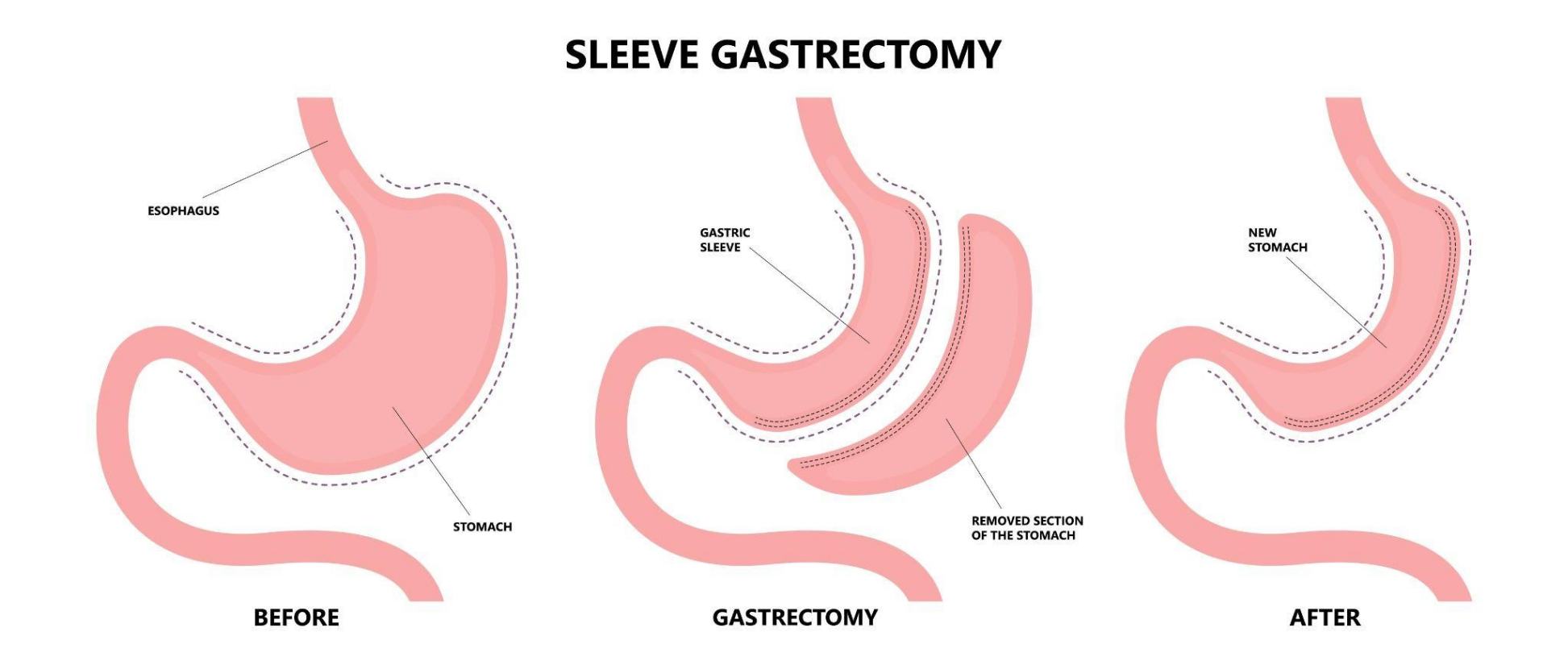 Complete/Total Gastrectomy