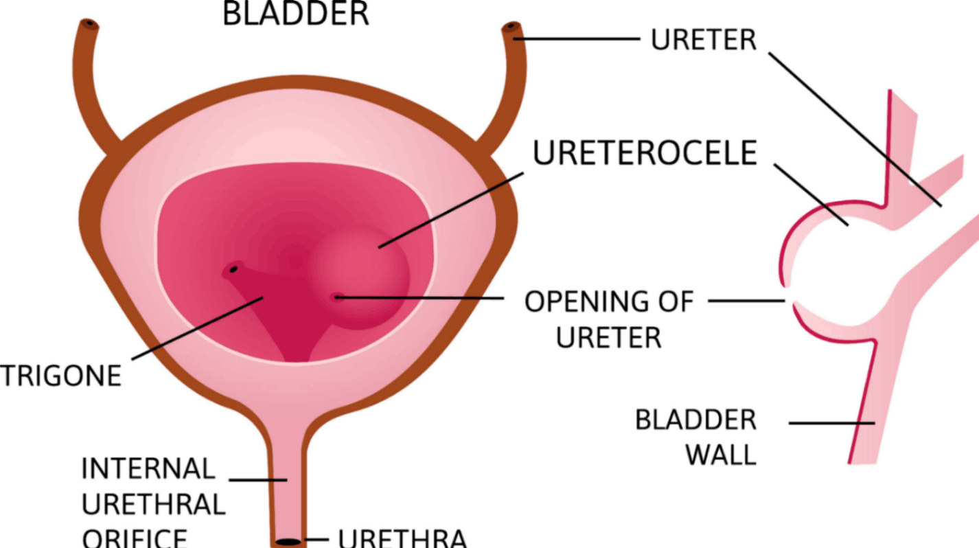 Ureterocele Figure 3 From Prolapsing Ectopic Ureterocele Presenting As
