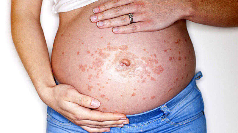 WHAT IS CHOLESTASIS OF PREGNANCY: SYMPTOMS, CAUSES, DIAGNOSIS, AND MORE ...