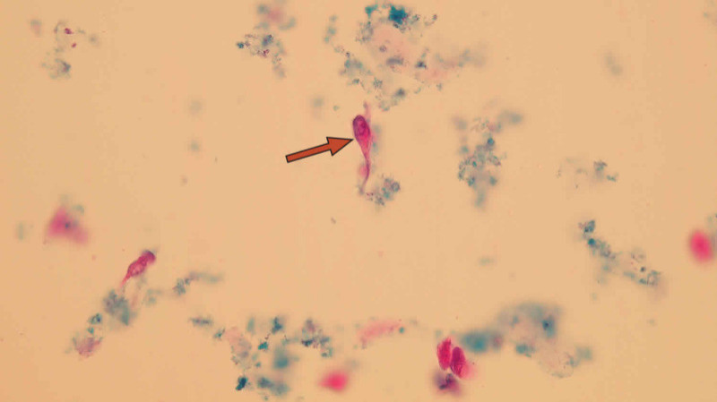 Squamous Epithelial Cells In Urine What Does It Mean Microscopic