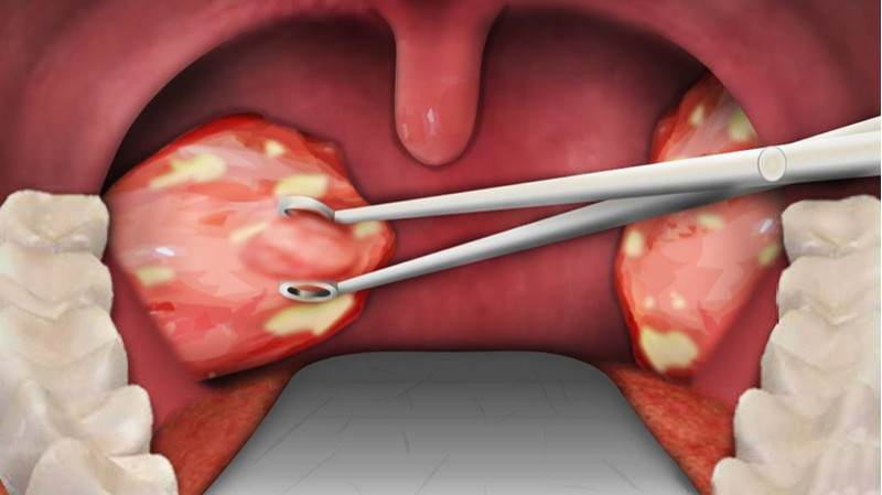 Tonsillitis