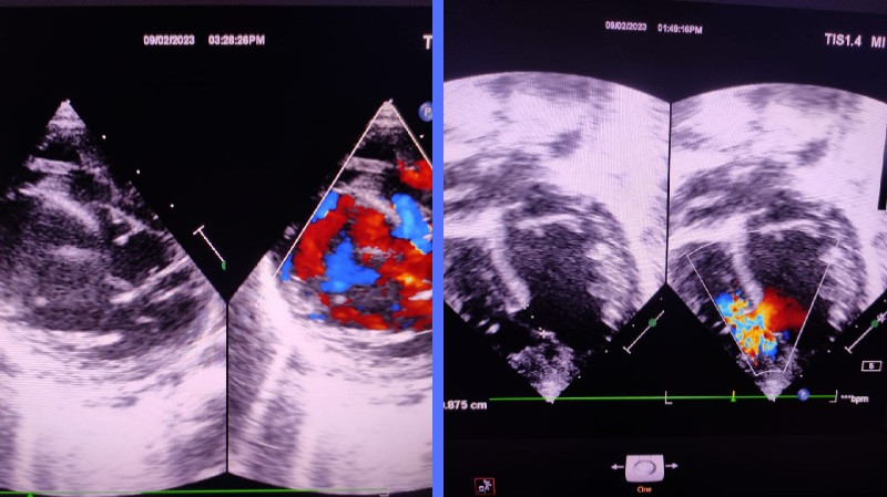 Ventricular Septal Defect Ultrasound