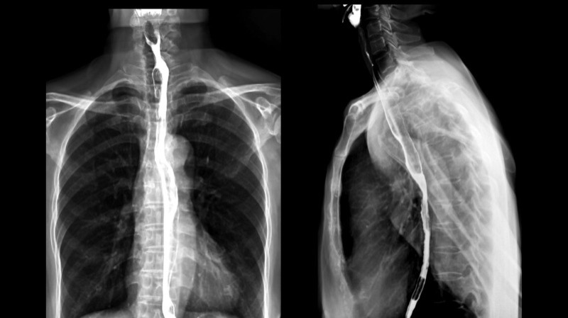 Esophageal Diverticulum Zenker's Diverticulum X Ray Wikidoc