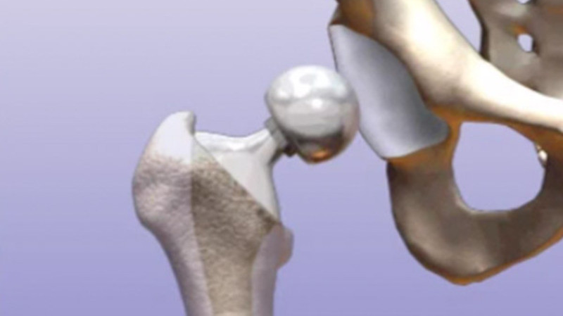 Partial Hip Replacement Replacement Surgery For Hip Fractures AAHKS