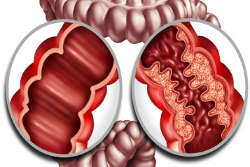crohns-disease-causes-symptoms-and-treatment-options_image