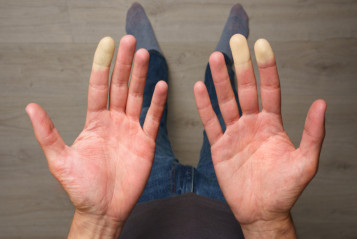 raynauds-disease-symptoms-causes-risk-factors-and-treatment-options_image