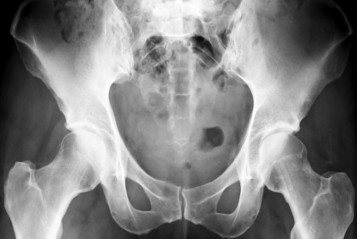 hip-arthroscopy-procedure-risks-and-recovery_image